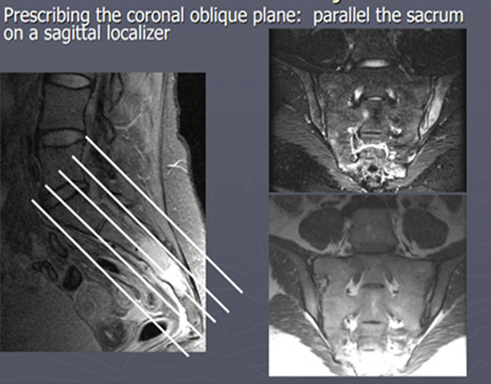MRI Sacroiliitis/SI Joints/Sacrum WO or W/WO MSK Protocol | OHSU